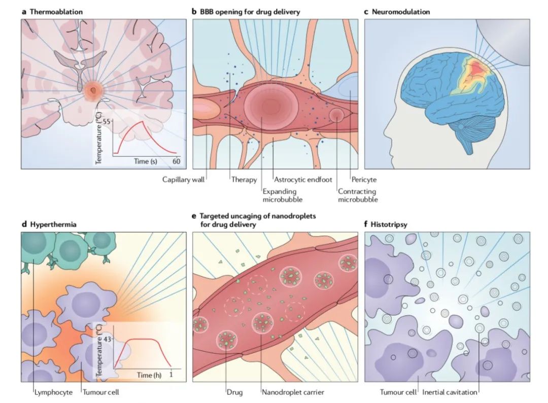 Nature Review Neurology聚焦超声在大脑中的应用：从热消融到药物输送 - 超微科学仪器