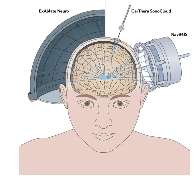Nature Review Neurology聚焦超声在大脑中的应用：从热消融到药物输送 - 超微科学仪器